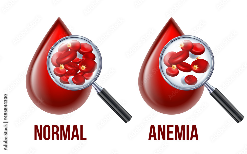 Iron deficiency anemia.The difference of Anemia amount of red blood ...