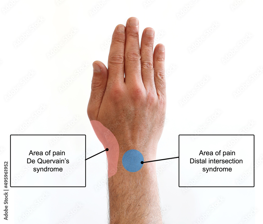 Compare pain area in wrist pain in De Quervain's syndrome and distal ...
