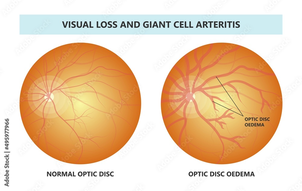 Vision loss Giant cell takayasu blood Horton's artery scalp swollen ...