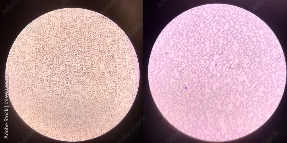Left blood smear non stain,Right blood smear with wright gimsa stain ...