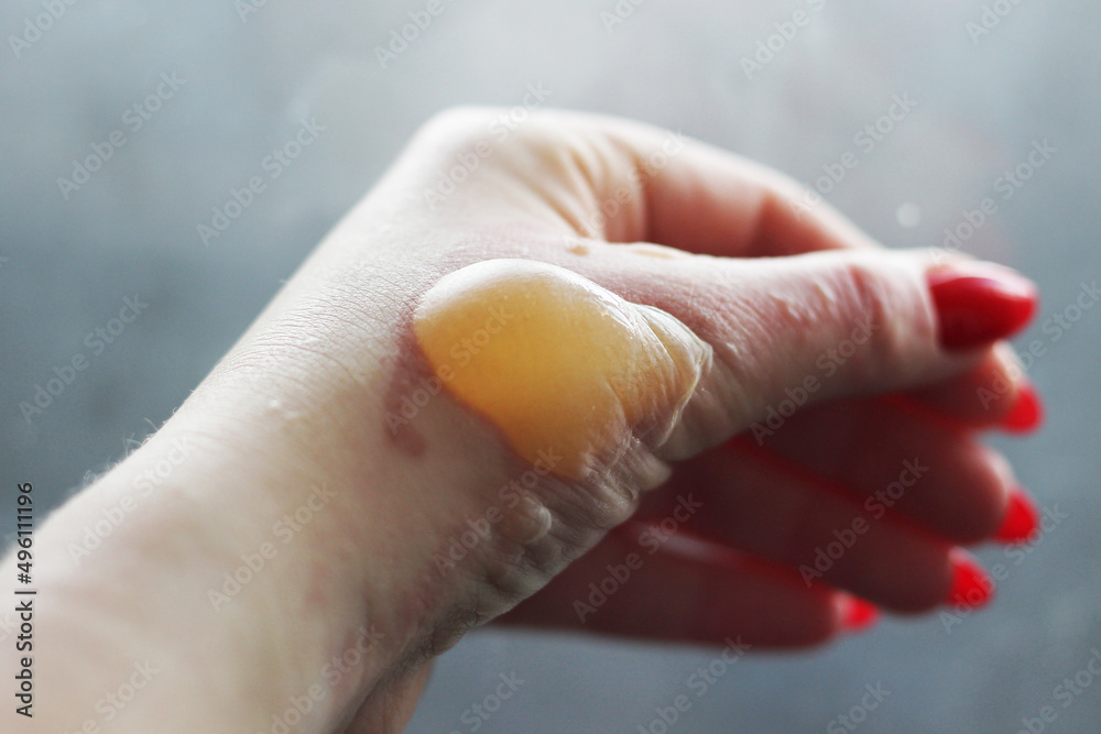 hand and fingers with real burn hot oil with bubble close-up foto de ...