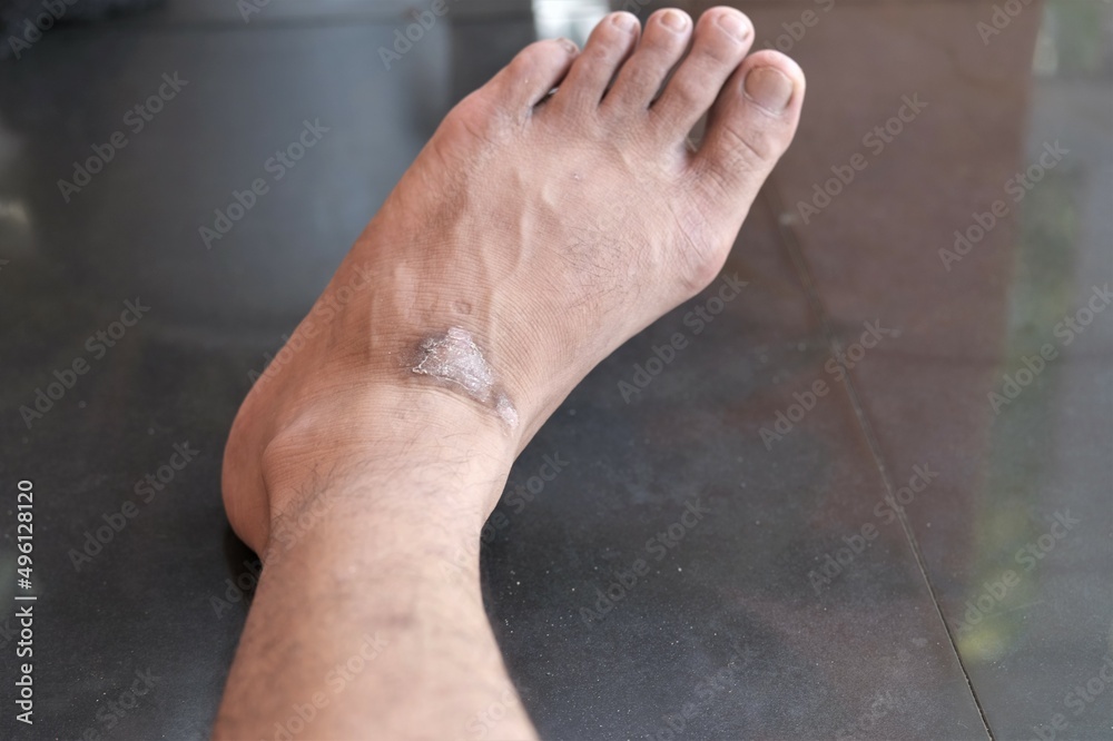 Athlete's foot, known medically as tinea pedis, is a common skin ...