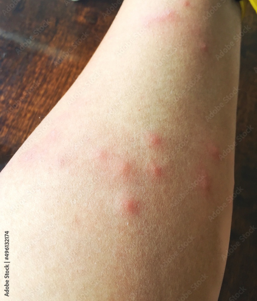 Skin diseases, rashes and itching on body. Stock Photo | Adobe Stock