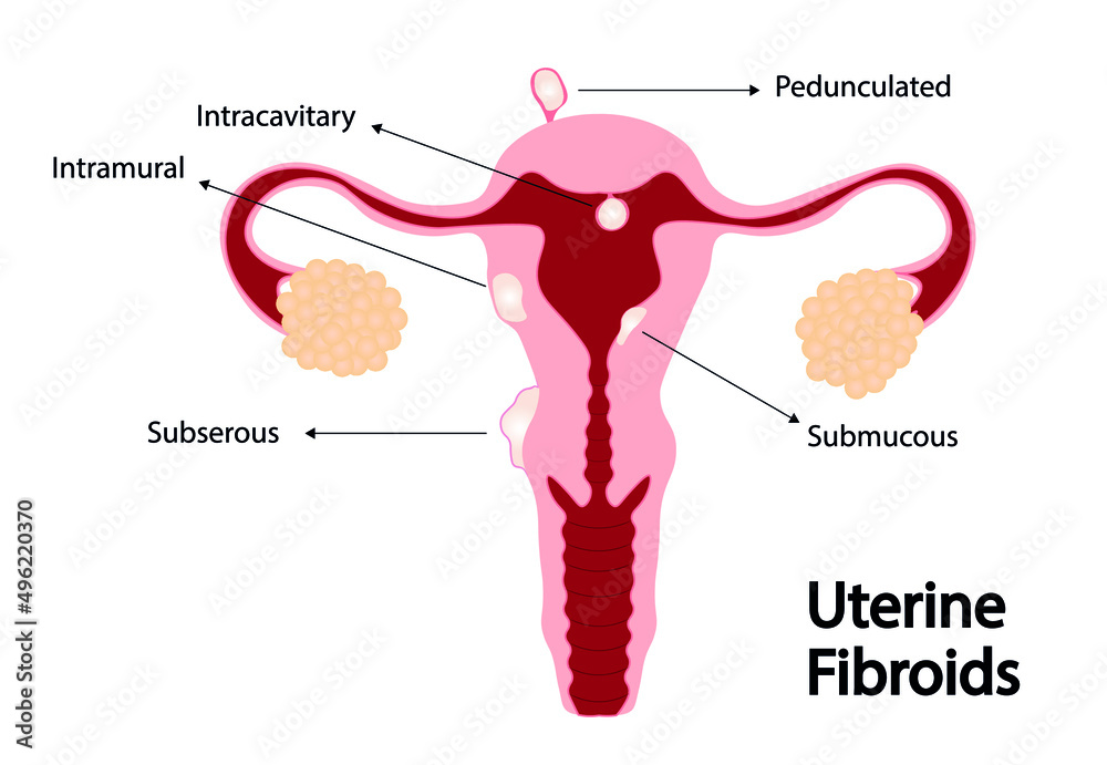 Uterine Fibroids Illustration Fibroids In The Uterus Also Called