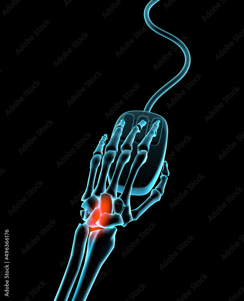 Skeleton of the human hand using a computer mouse showing carpal tunnel ...