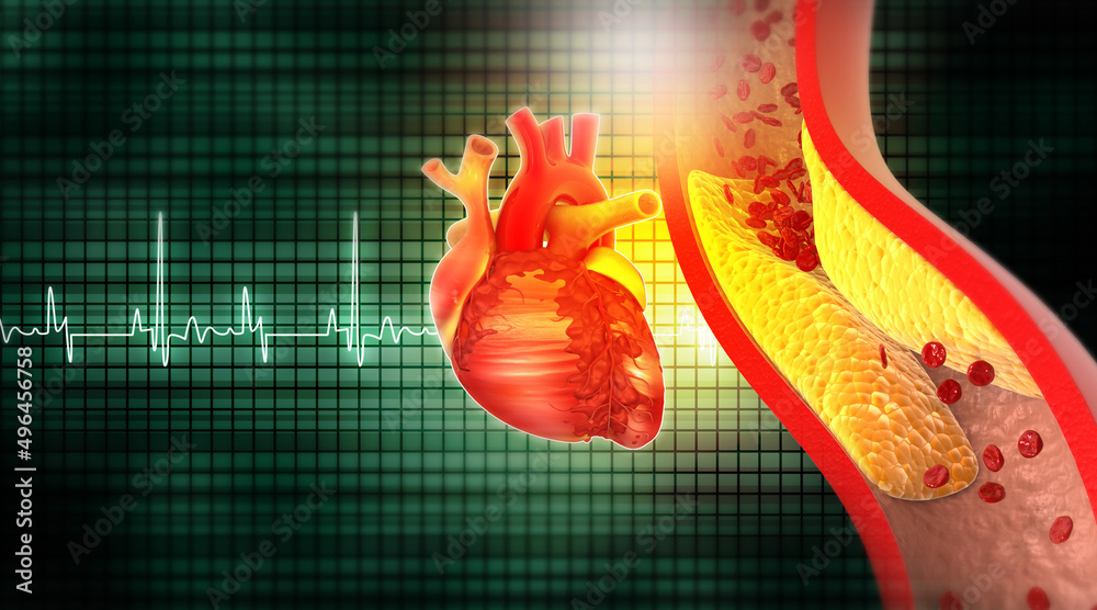 Blockied artery with human heart. medical background. 3d illustration ...