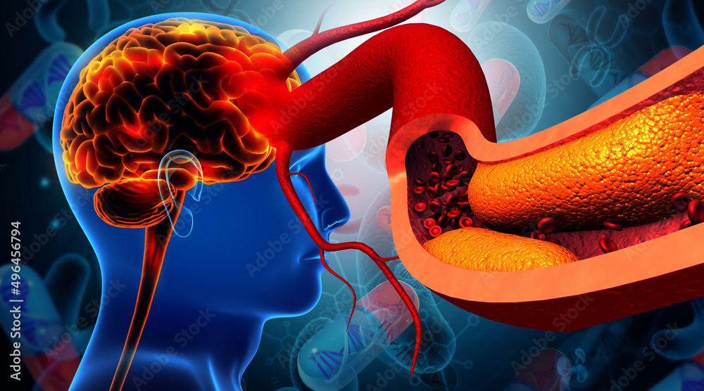 Human brain with Blood clot blocks in an artery, stroke concept. 3d ...