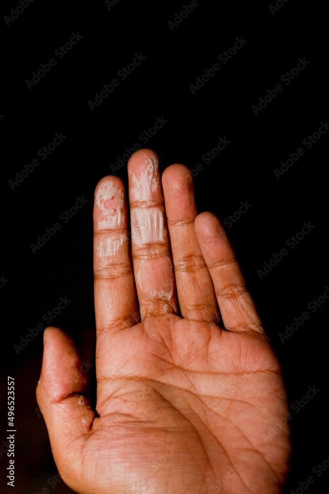 The dry skin in hands, peel, contact dermatitis, fungal infections ...