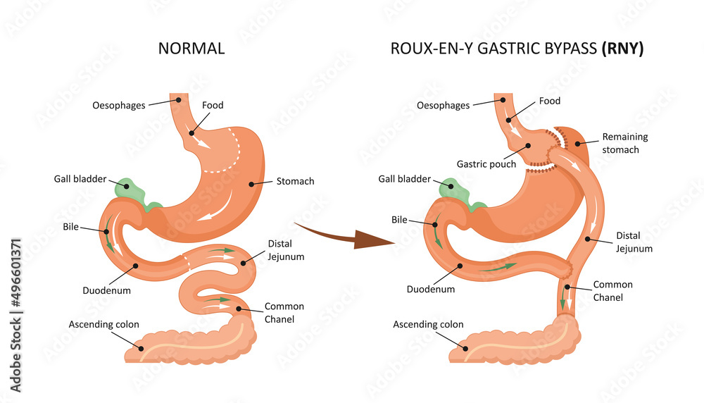 Roux-en-y gastric bypass (RNY). Showing a gastric pouch and ... Roux-en-y gastric bypass (RNY). Showing a gastric pouch and ...