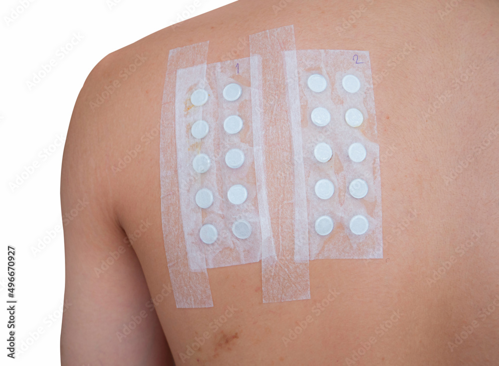 Applying Patch Test to test for chronic allergic rash from chemical ...