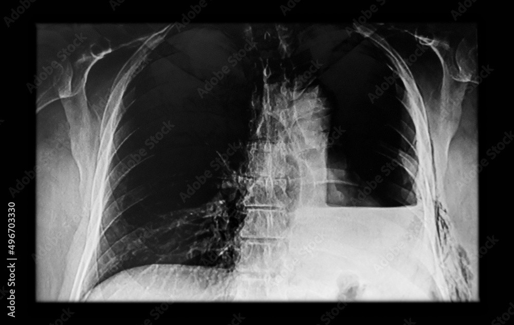 Chest X- ray showing a left pneumonectomy and left effusion. Medical ...