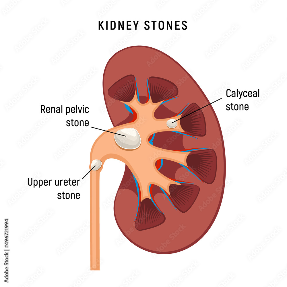 Kidney cartoon stones disease vector infographic. Urinary renal kidnay ...