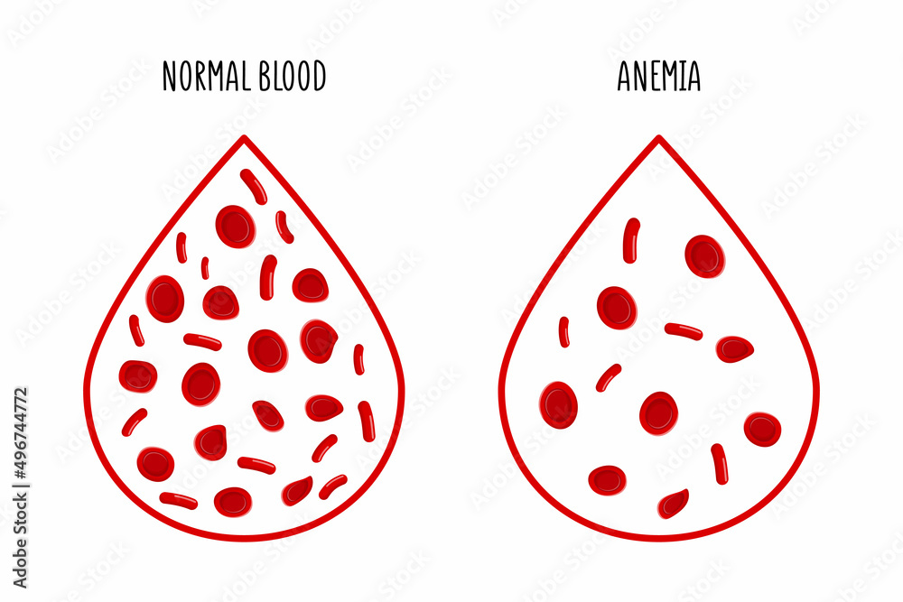 The difference of Anemia amount of red blood cell and normal ...