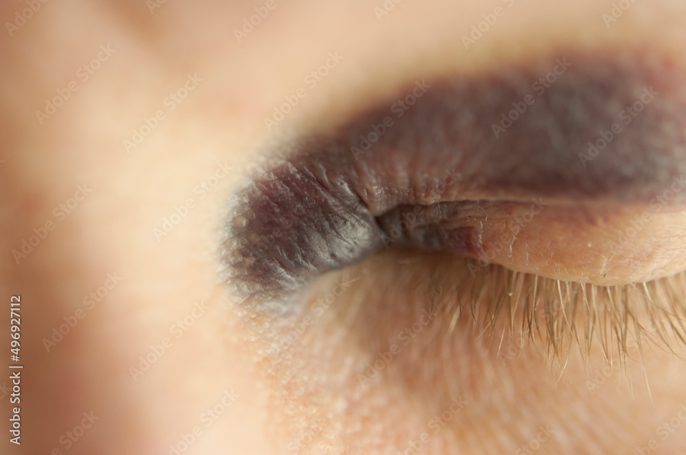 Sad beaten up girl with wounds on the face looking at the camera with ...
