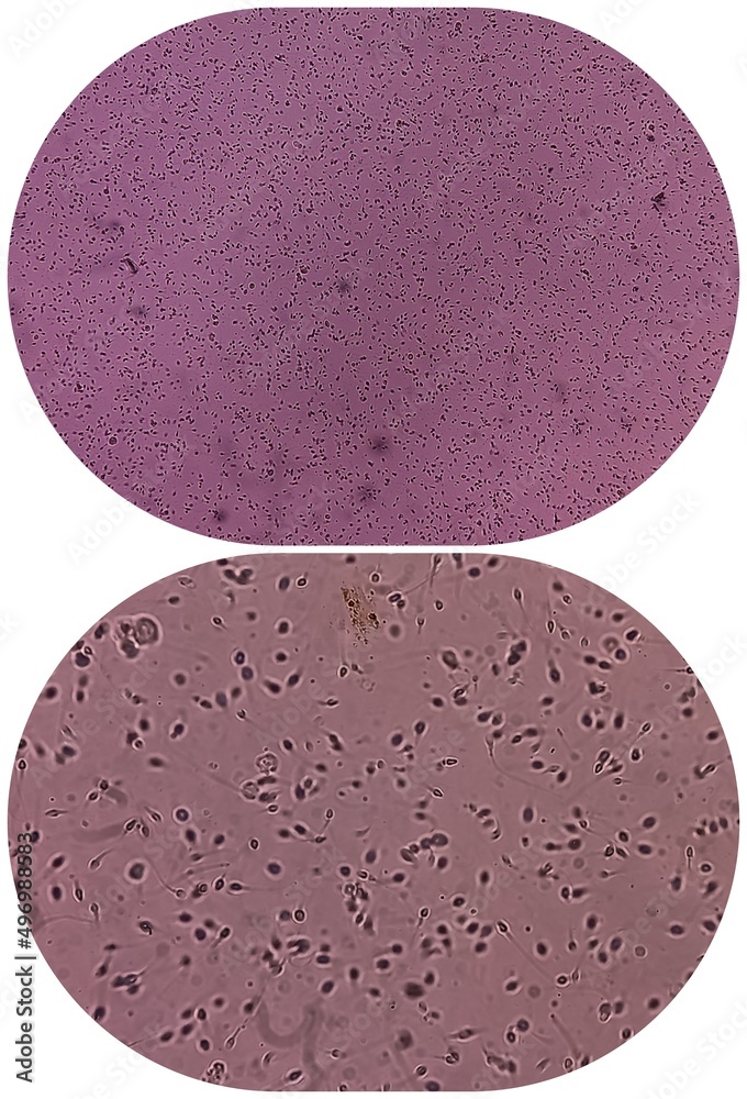 Semen analysis, sperm analysis on microscopic examination ...