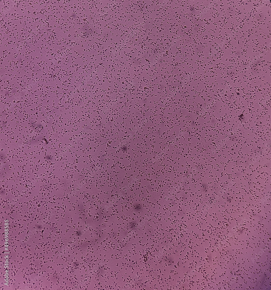 Semen analysis, sperm analysis on microscopic examination ...