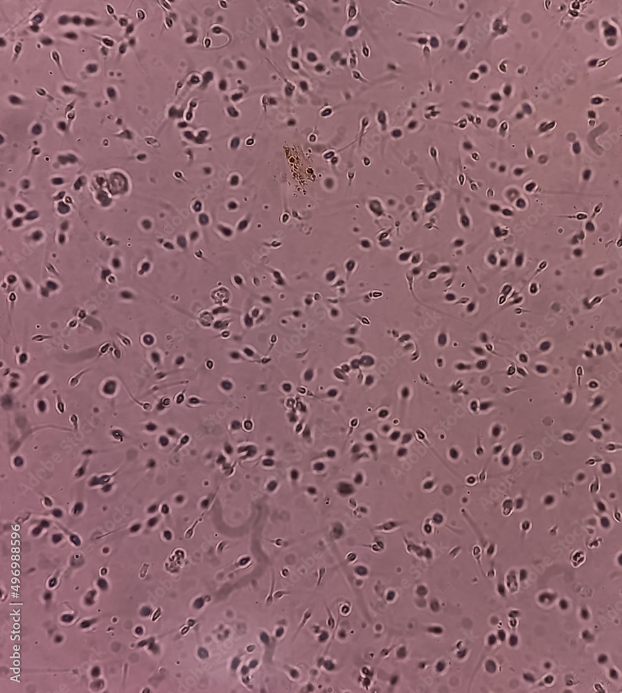 Semen analysis, sperm analysis on microscopic examination ...
