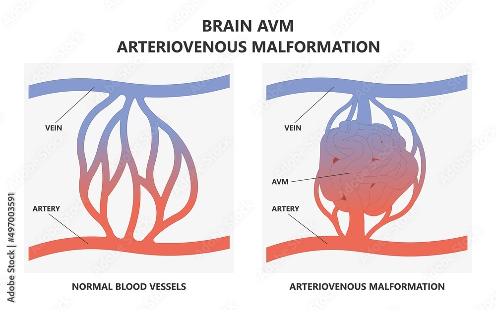 capillaries system stroke scalp brain ct scan X-ray image mri diagnose ...