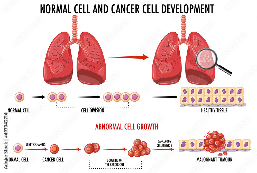Diagram showing normal and cancer cell Stock Vector | Adobe Stock