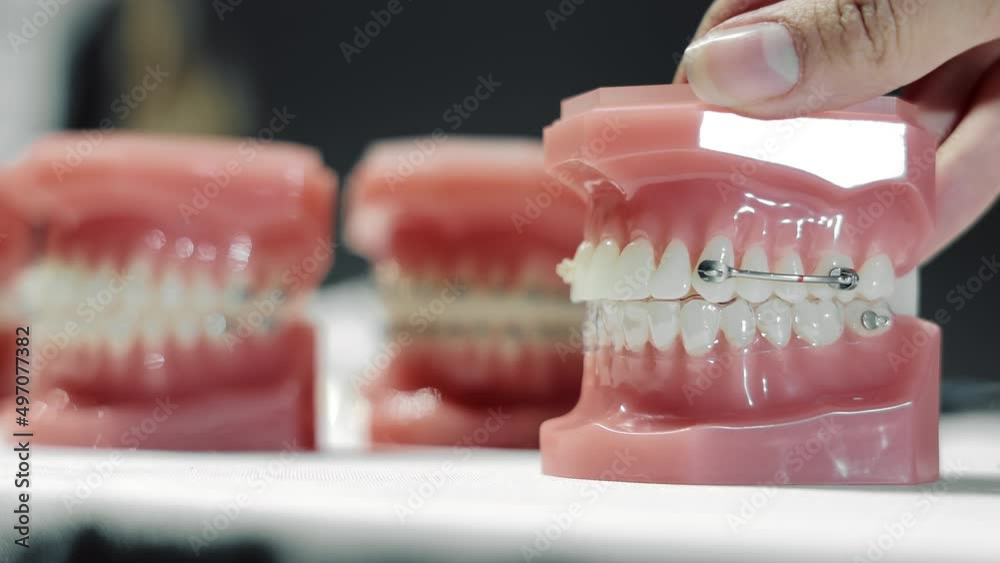 Model of the tooth gap on the placement of orthodontic brackets ...