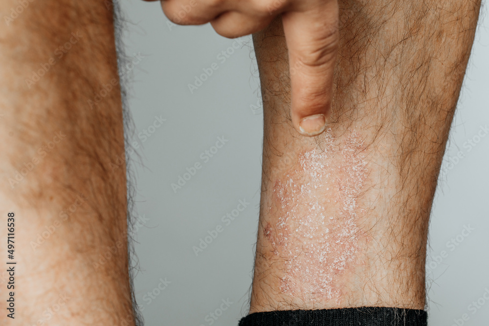 Acute psoriasis na is an autoimmune incurable dermatological skin ...