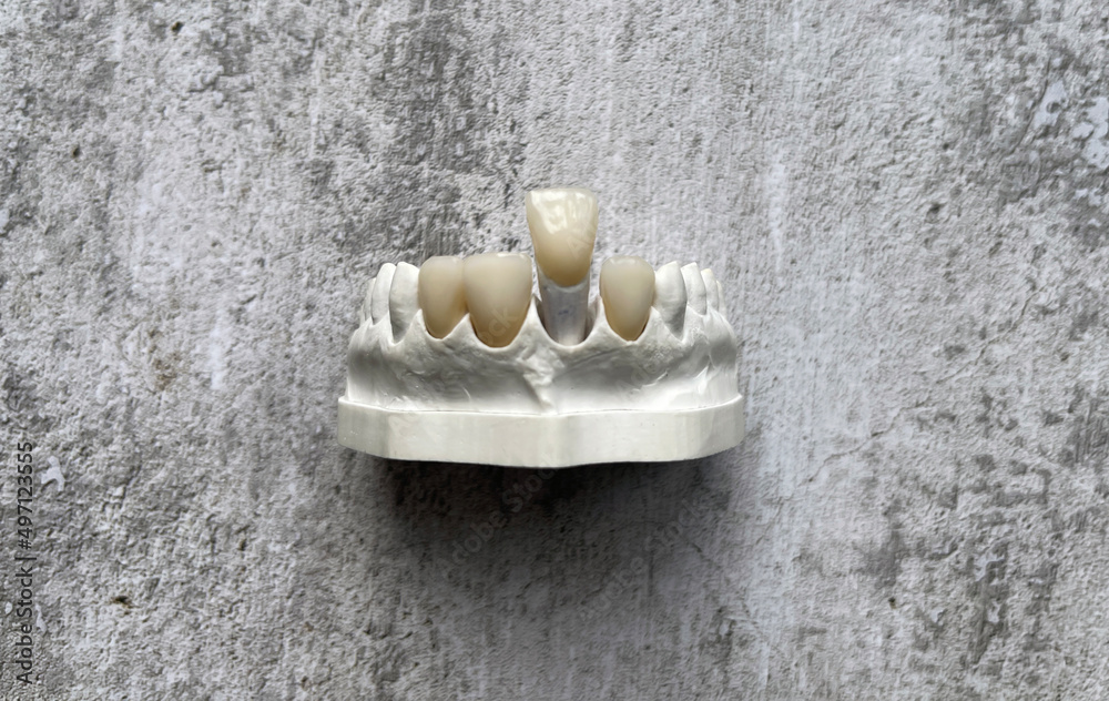 Dental veneers on a demountable model in the laboratory. Collapsible ...