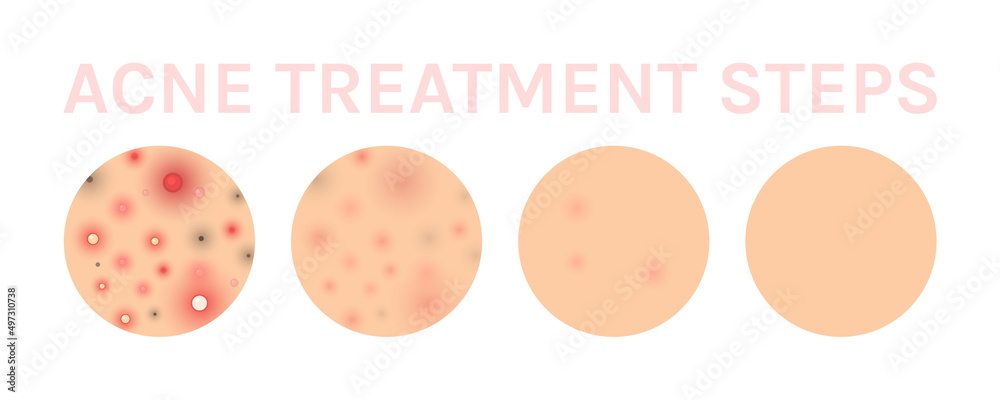 Acne Treatment Steps. Whitening of Human Skin. Facial Pimples on ...