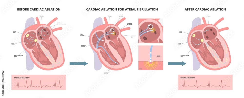Atrial fibrillation minimally invasive procedure attack Cardiac catheter ablation rhythm problem ...