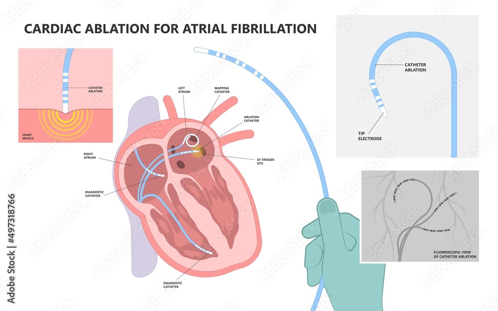 Plakat Atrial fibrillation minimally invasive procedure attack Cardiac catheter ablation rhythm ...