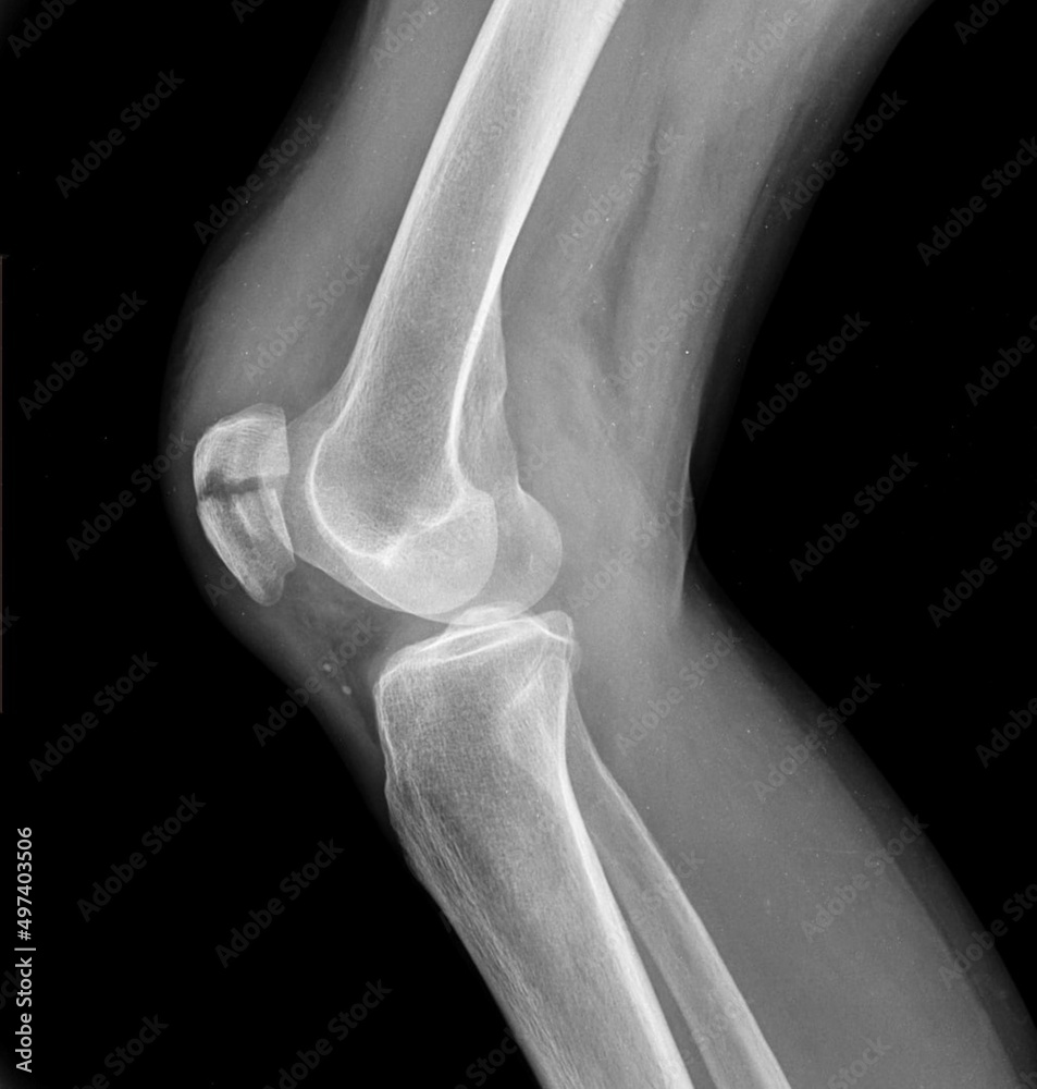 A knee xray reveals a patellar fracture. The patella is the small bone ...
