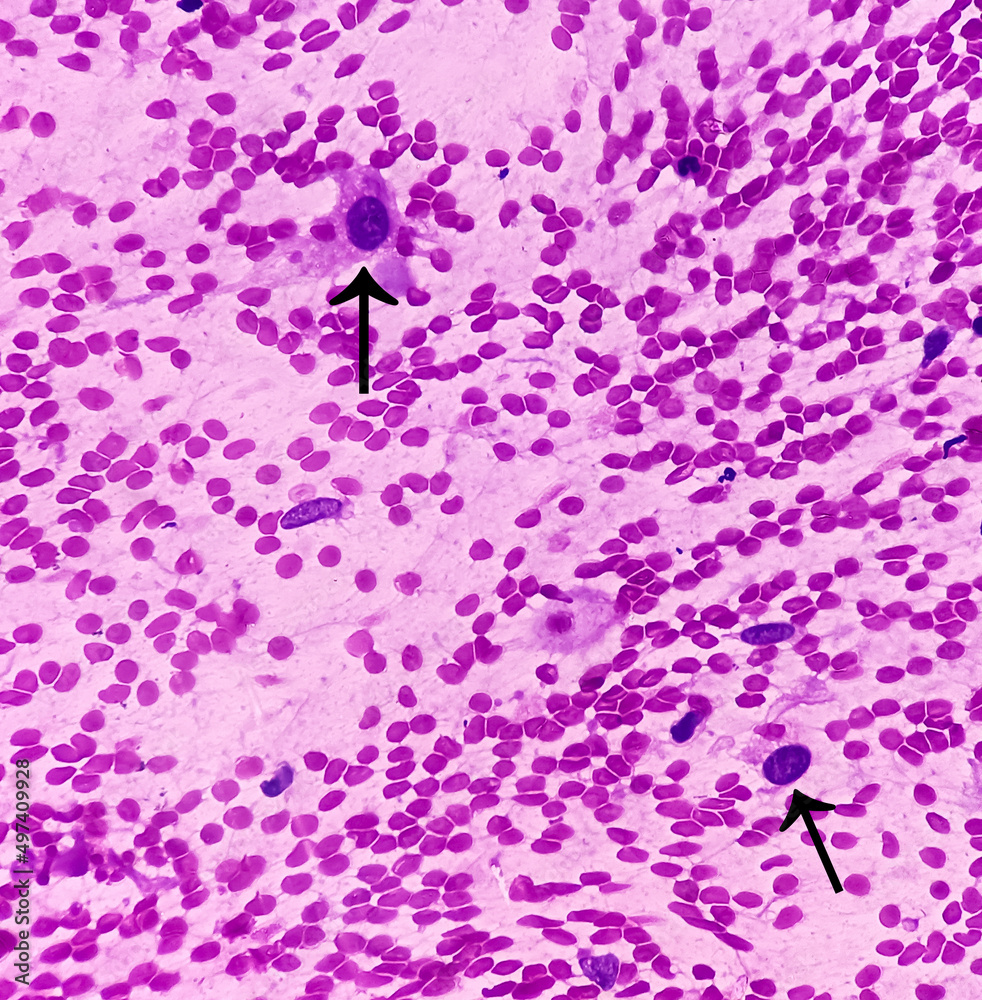 Atypical cells, smear show mostly regular oval to spindle shaped cells ...