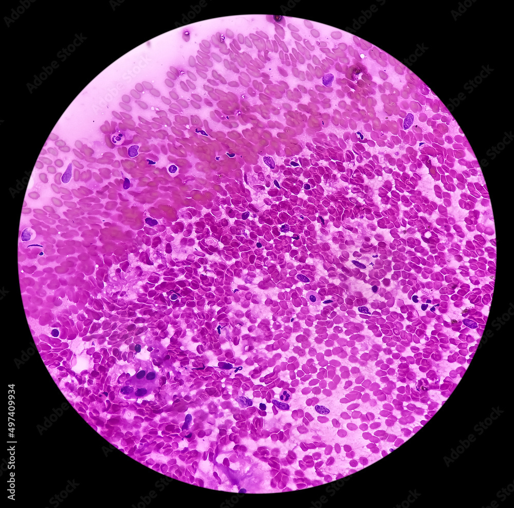 Atypical cells, smear show mostly regular oval to spindle shaped cells ...