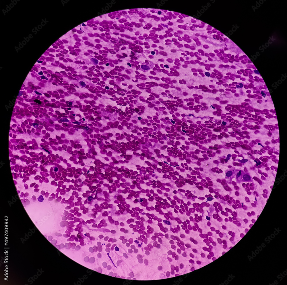 Atypical cells, smear show mostly regular oval to spindle shaped cells ...