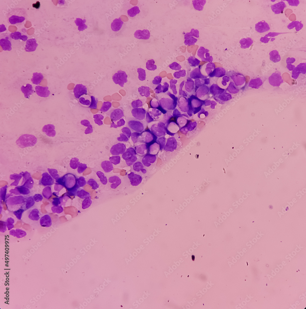 Chronic myeloid leukemia(CML) is a type of blood cancer. show the ...