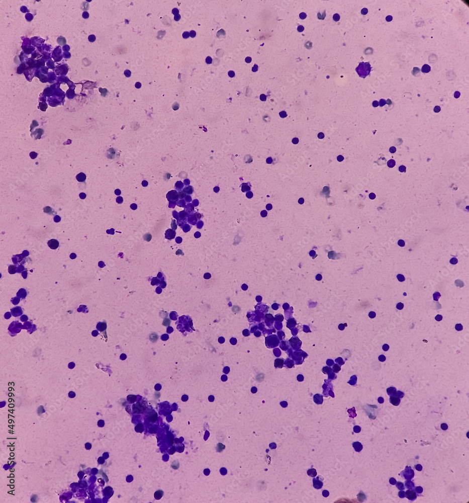 Ascitic fluid cytology: microscopic show lymphocyte cell, some ...