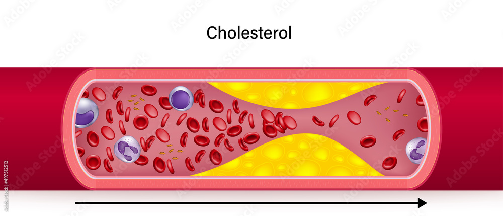 Cholesterol in blood vessels. Red blood cells, Platelets and White ...