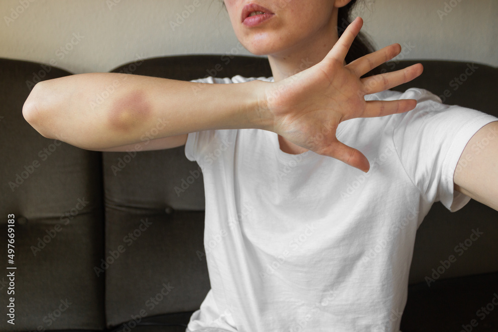 Young woman in white t-shirt with large bruise on arm. Say stop to ...