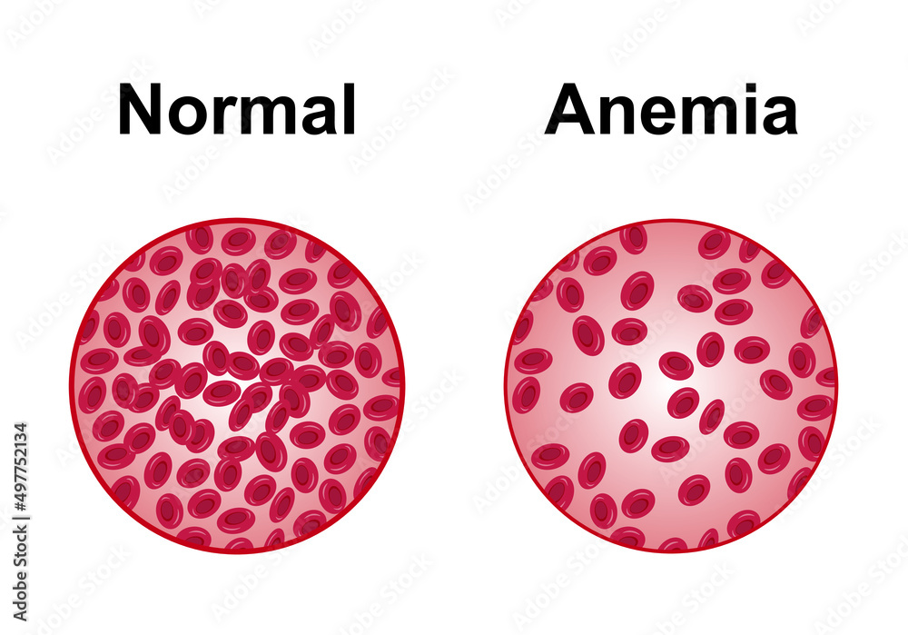 Scientific Designing Of Anemia Symptoms. Normal And Anemia Blood ...