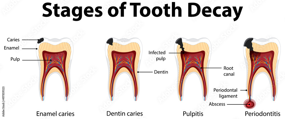 Infographic of human in the stages of tooth decay Stock Vector | Adobe ...