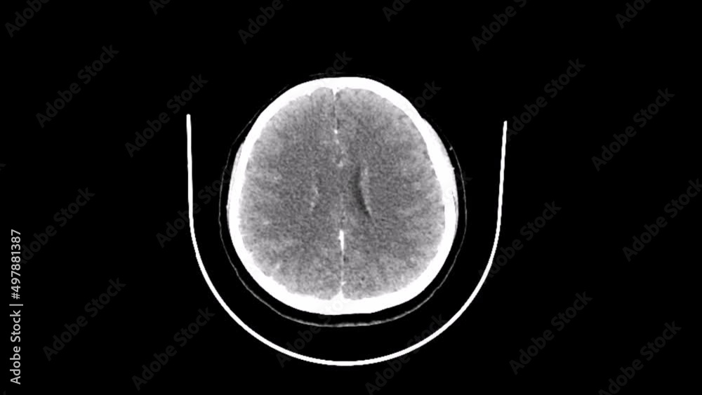 Vidéo Stock Axial Ct Scan Of Right Sphenoid Wing Meningioma Adobe Stock