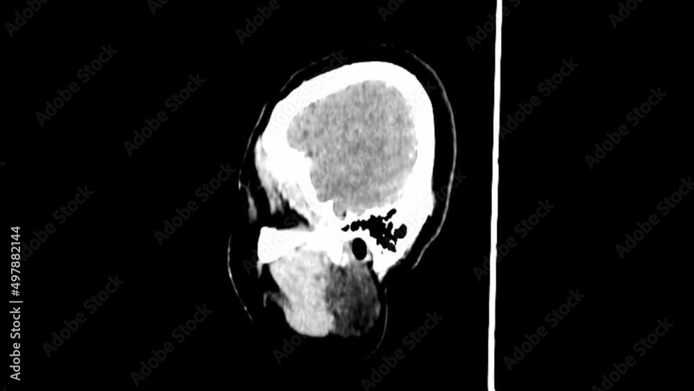 sagittal ct scan of right sphenoid wing meningioma Stock ビデオ | Adobe Stock