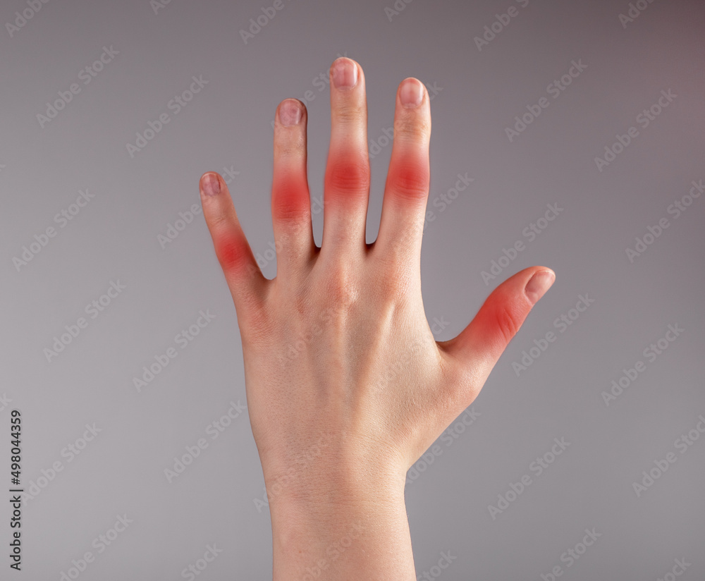 Finger joint pain. Woman hand with red spot closeup. Causes of injuries ...