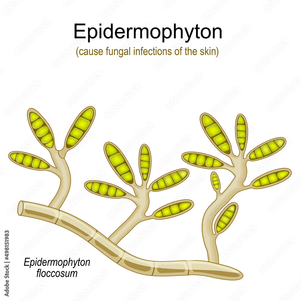 Epidermophyton floccosum. fungal infections of the skin. Vector ...