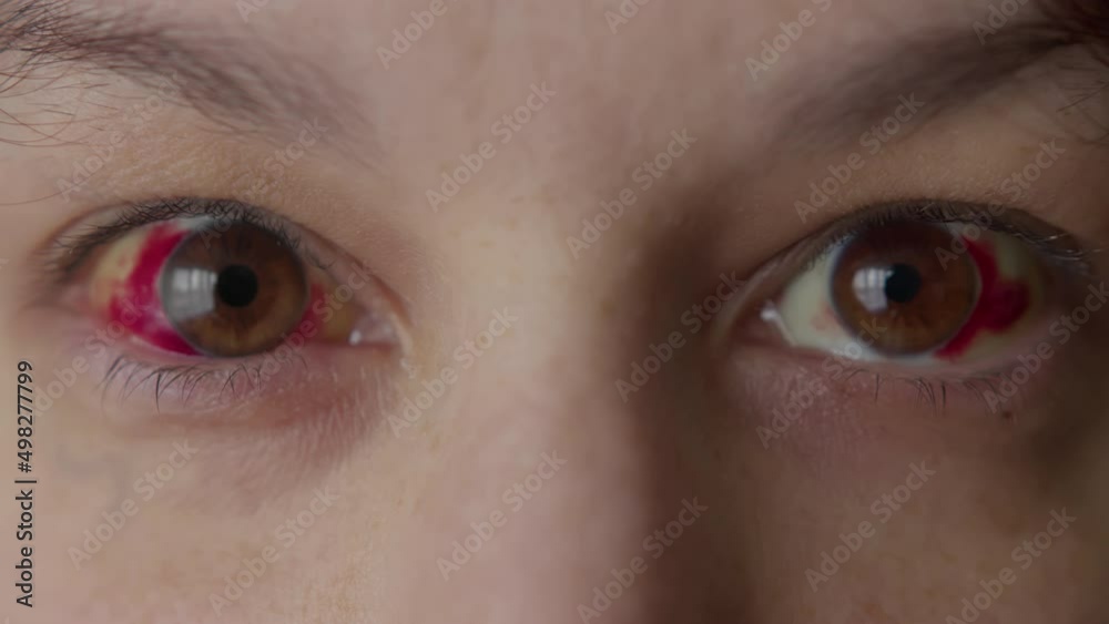 Vidéo Stock Glaucoma. Female red eyes filled with blood. Burst ...