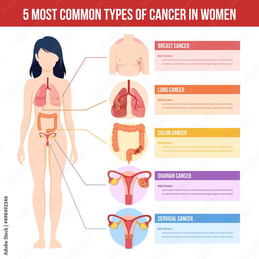 Infographic 5 Most Common Types of Cancer in Woman. Stock Vector ... Infographic 5 Most Common Types of Cancer in Woman. Stock Vector ...