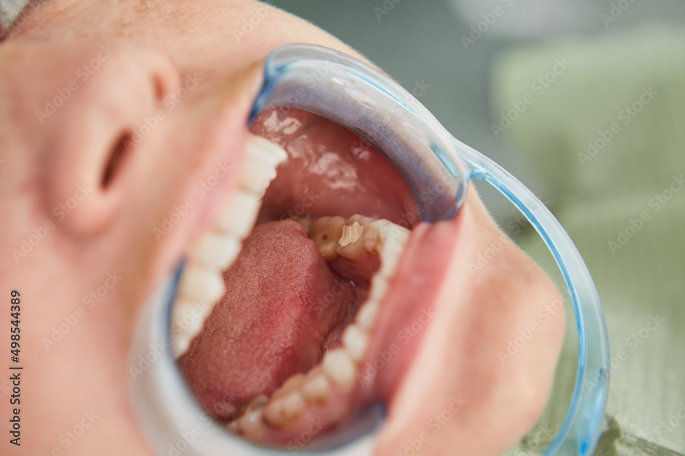 Patient with cheek retractor in mouth receiving dental treatment. Stock ...