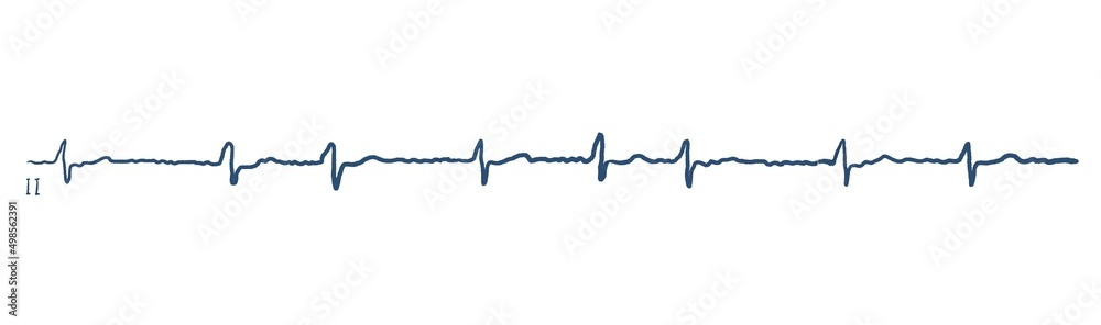 ECG image show atrial fibrillation, vector illustration Stock ...