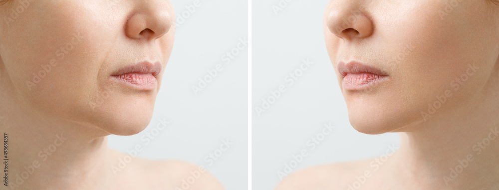 A close portrait of an aged woman before and after facial rejuvenation ...