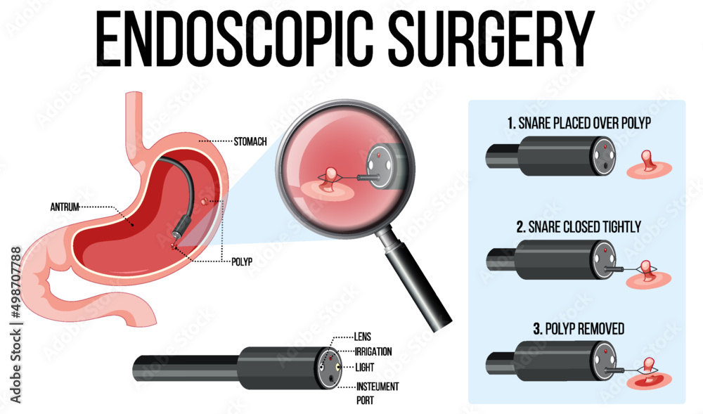 Diagram showing endoscopic surgery Stock Vector | Adobe Stock