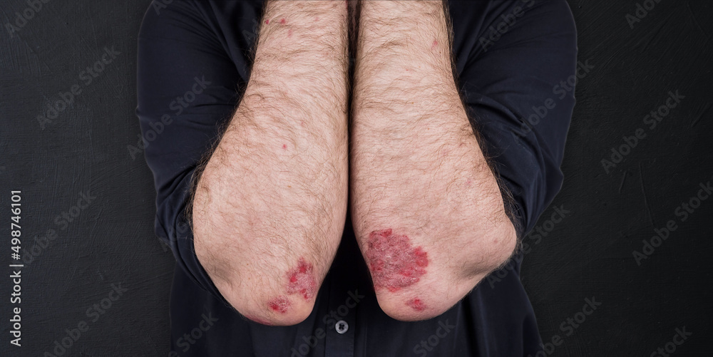 Psoriasis. Autoimmune genetic disease. A man with sore hands, dry flaky ...